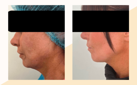 MINT PDO Thread Lift in Liverpool | Bold Street Clinic